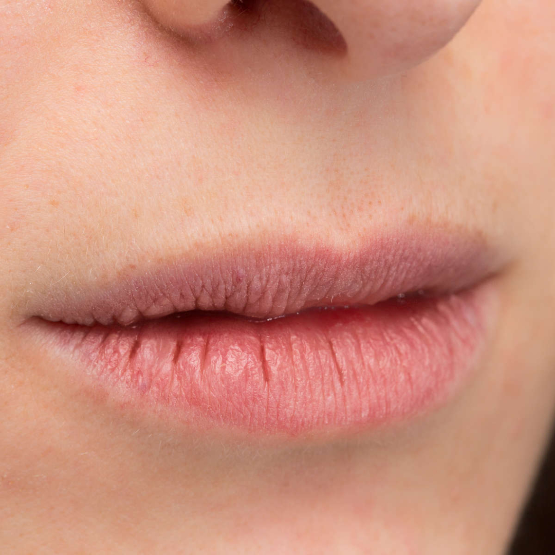 Labbra secche e screpolate: rimedi e prodotti naturali